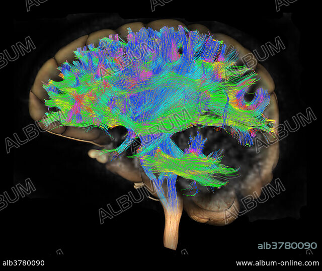 Diffusion Tensor Imaging (DTI) - Fiber Tracking