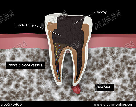 Pulp Cavity