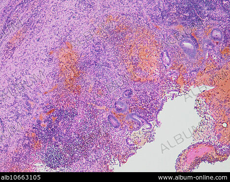 Pretibial Myxedema Pathology