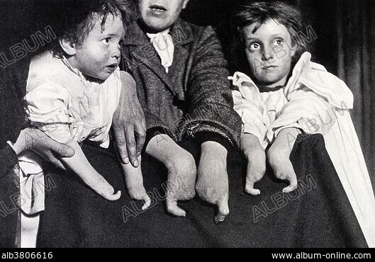 Split Hand Split Foot Malformation