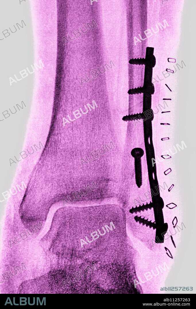 Osteosynthesis on a fracture of the fibula - Album alb11257263