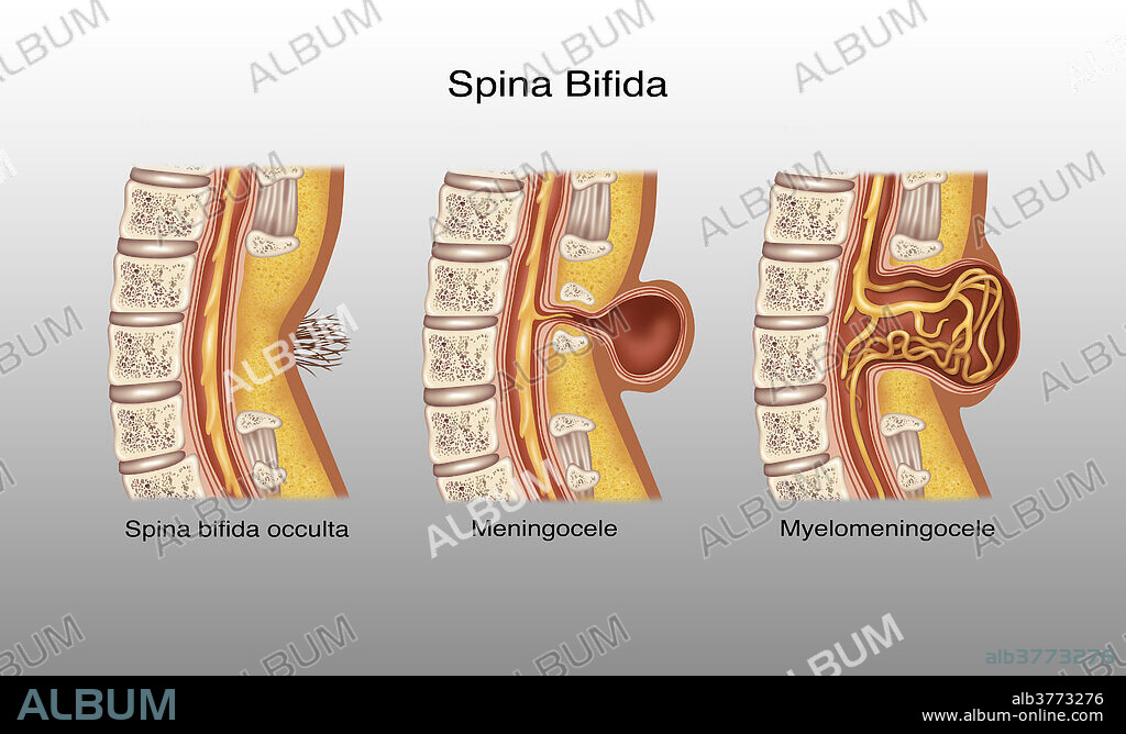 Spina Bifida Types - Infoupdate.org