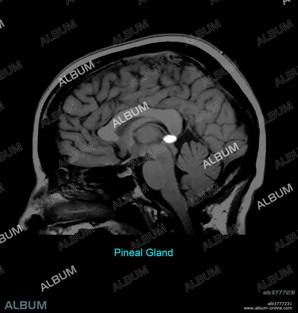 Normal Pineal Gland